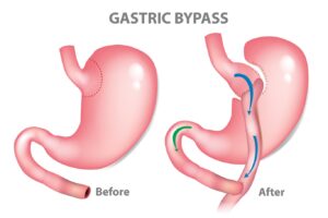 Bariátrica bypass: tudo o que você precisa saber